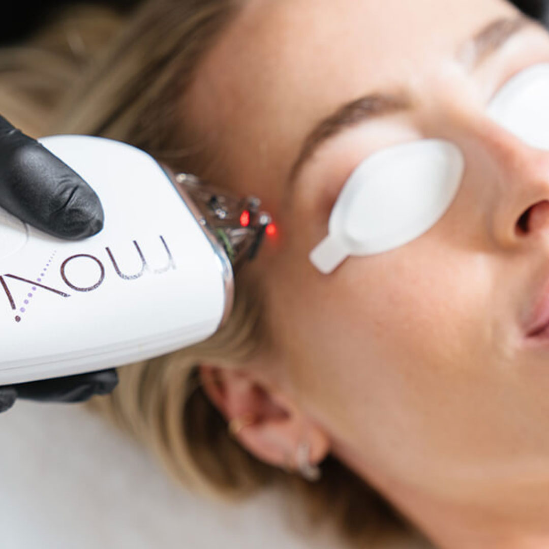 Sciton MOXI Laser tulowy - Klinika Spire Clinic - Efekt „baby face ...