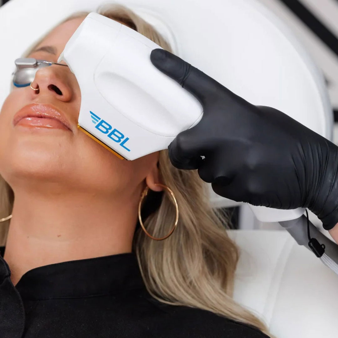 Sciton BBL HEROic Forever Young - Klinika Spire Clinic - Odmładzanie Genowe